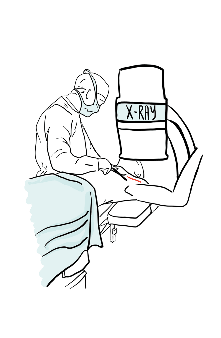 Removal of Clavicle Plate: Post-Operative Care