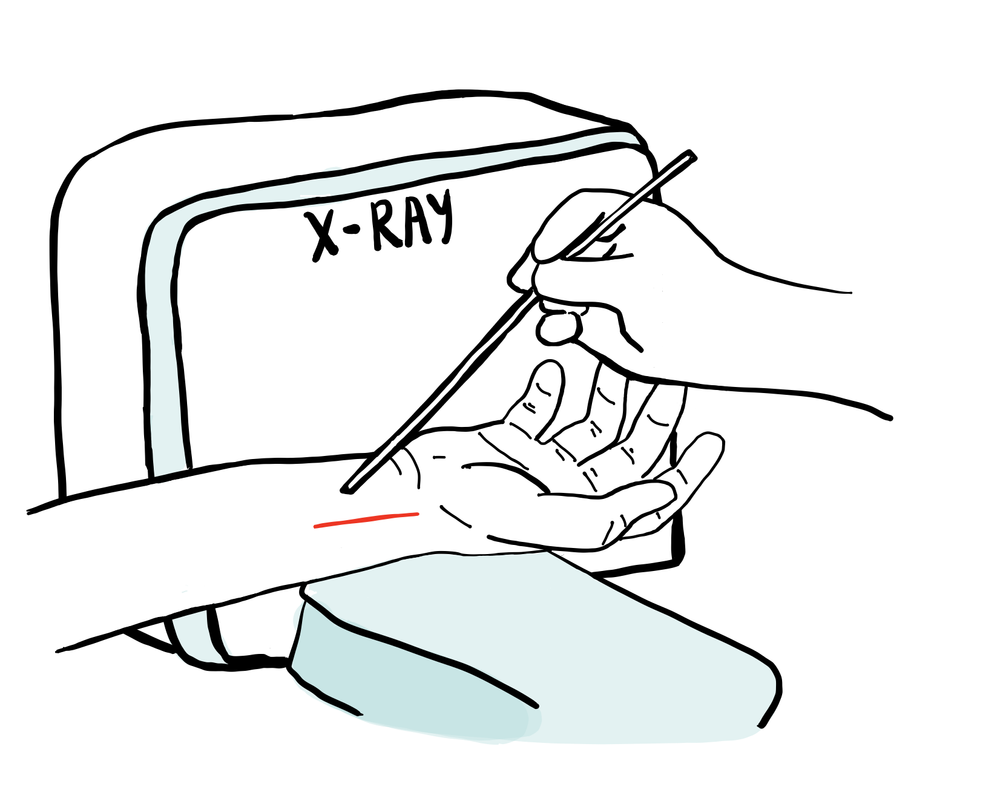 Removal of Wrist Plate