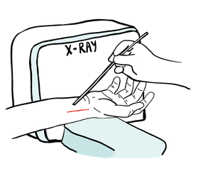 Removal of Wrist Plate