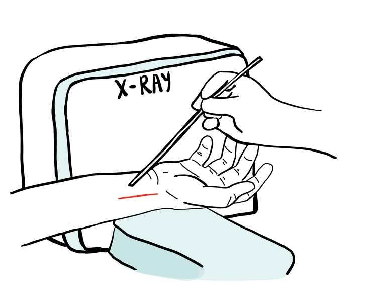 Removal of Wrist Plate