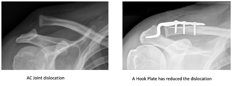 Clavicle Fracture Treatment