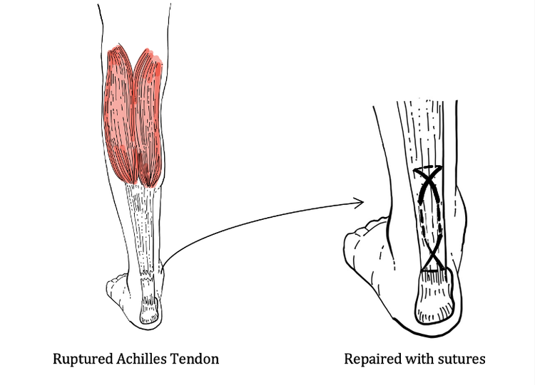 Achilles Ruptures and Treatment Options