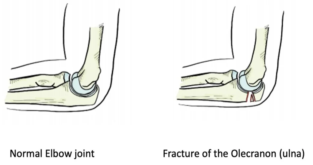 Olecranon Fractures