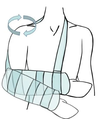 Clavicle Fracture Treatment