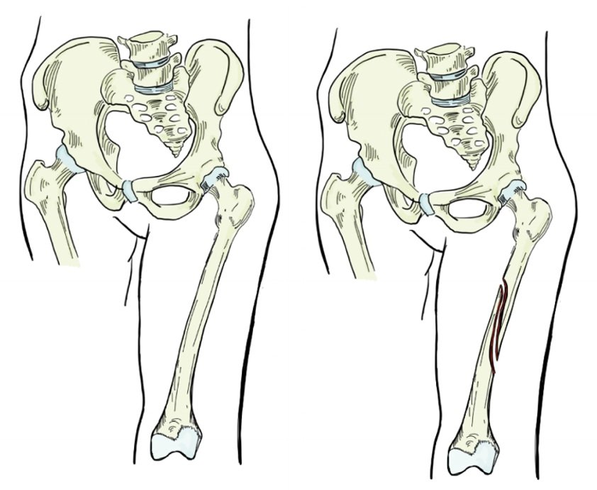 Mid-shaft Femur Fracture