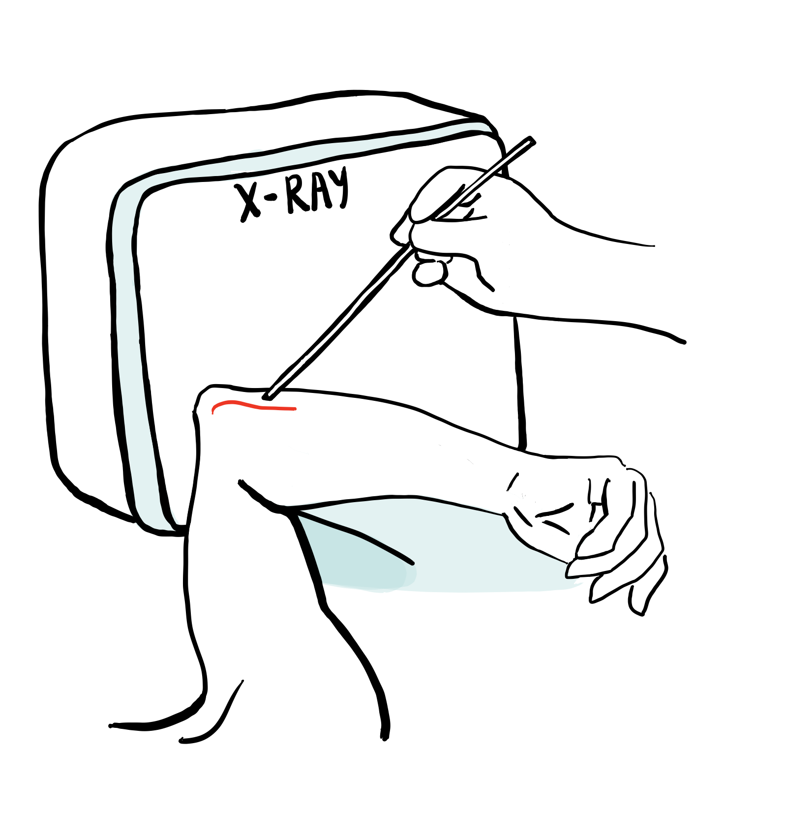 Removal of Elbow Plates