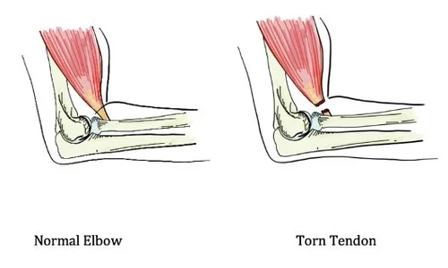 Distal Bicep Tear