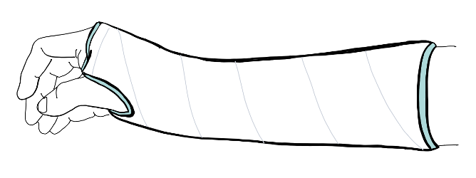 Wrist Fracture Treatment