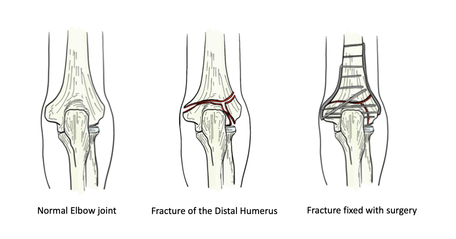 Distal Humerus Fracture Treatment