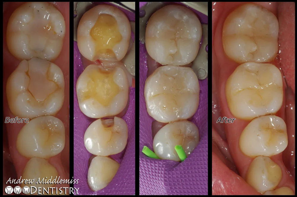 Restorations Before-After | Andrew Middlemiss Dentistry - Wellington CBD