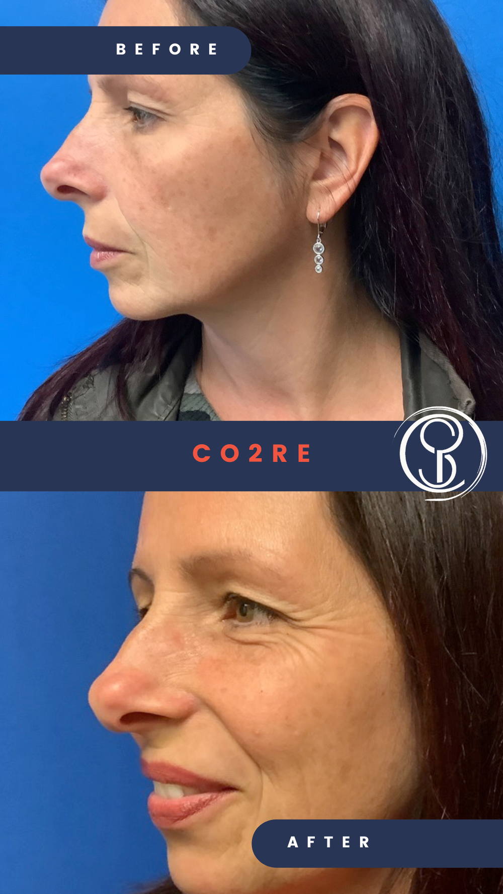 CO2RE — Chao Plastic Surgery