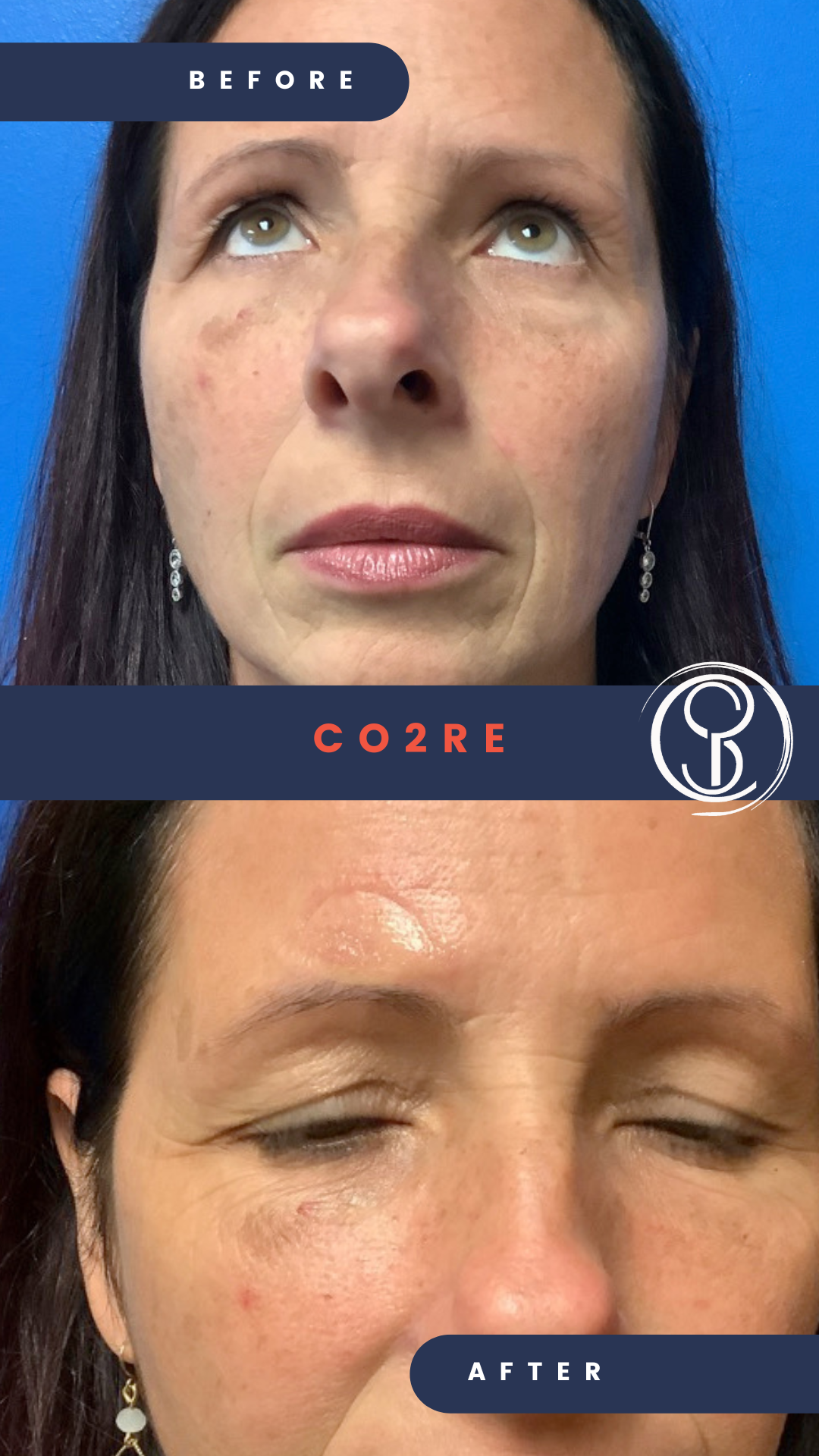 CO2RE — Chao Plastic Surgery