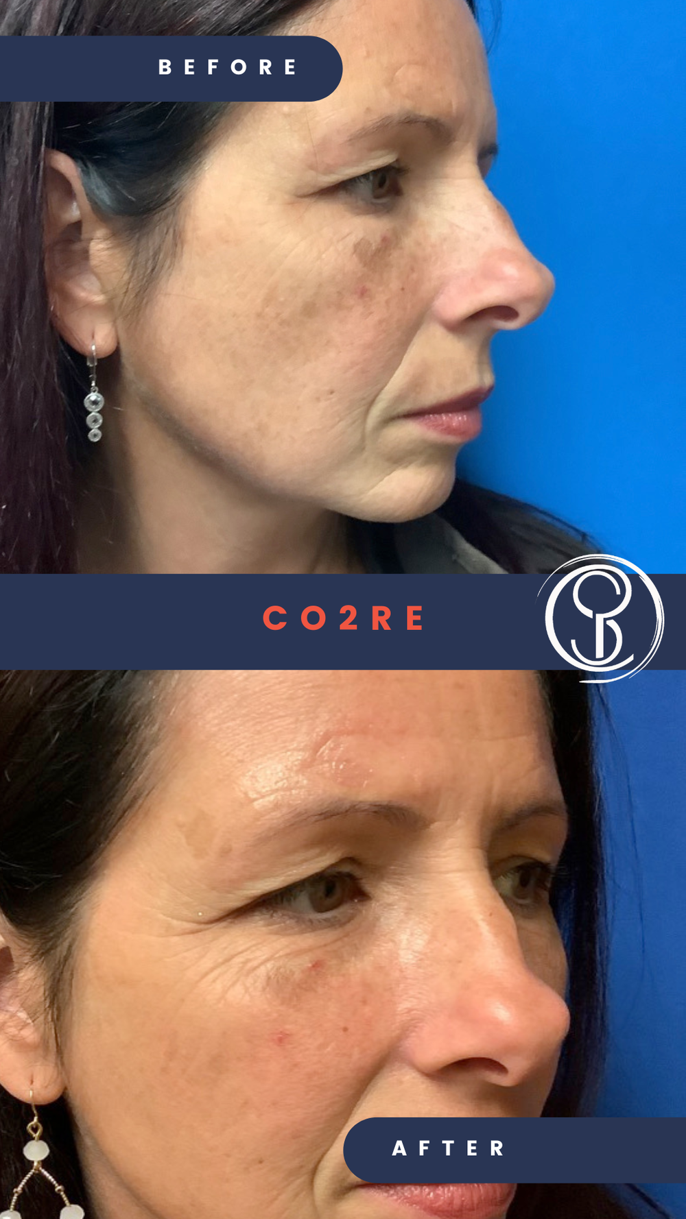 CO2RE — Chao Plastic Surgery