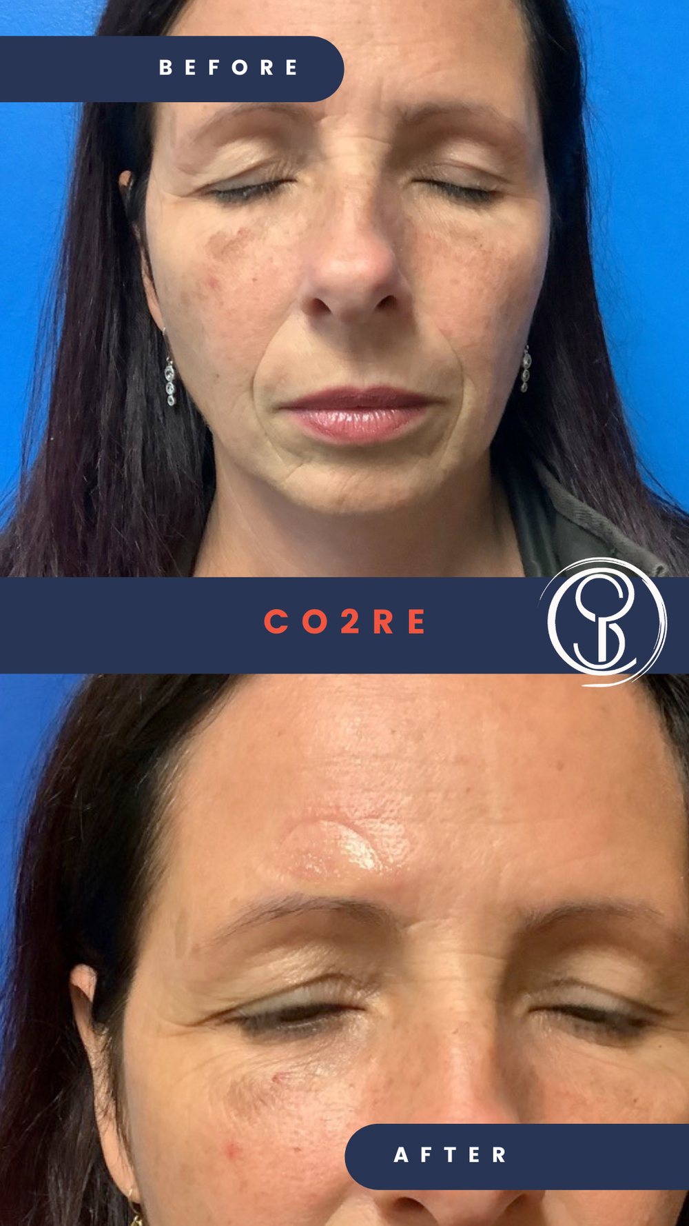 CO2RE — Chao Plastic Surgery