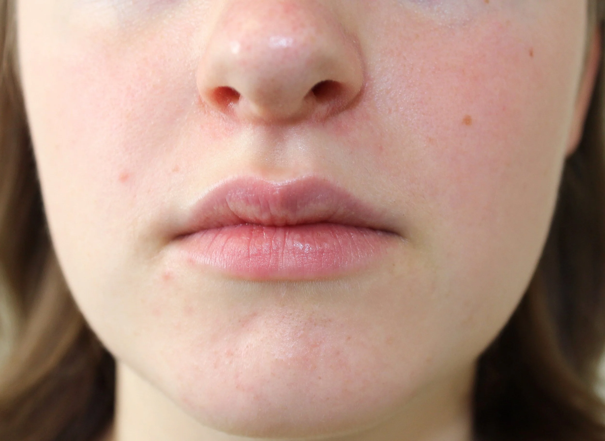 Perioral Dermatitis: Natural Treatments - Homeopathy & Integrative ...