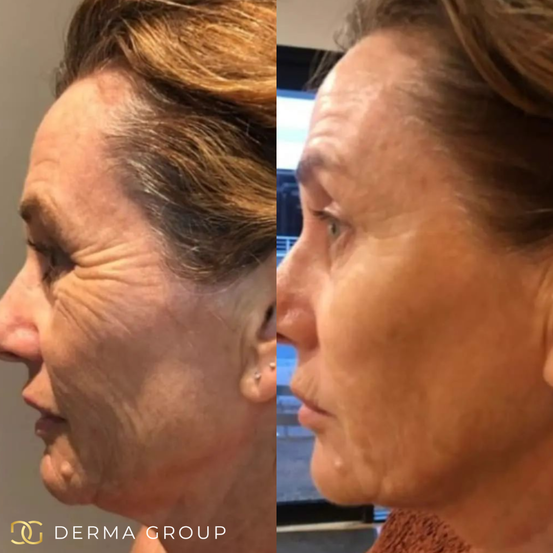 RF Micro needling Launch deals | Treat Yourself Today – Book Now ...