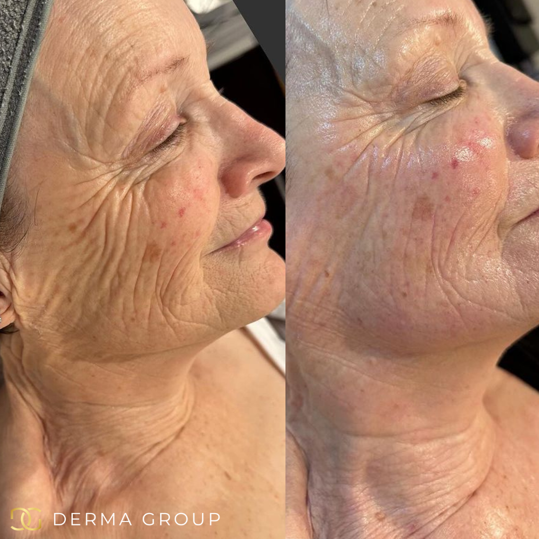 RF Micro needling Launch deals — Karma laser skin beauty salon