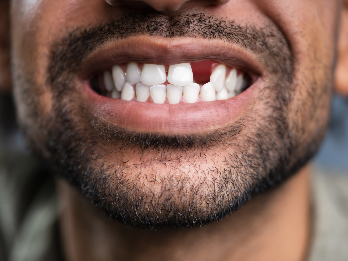 Options for Replacing Missing Teeth — Ever After Dental
