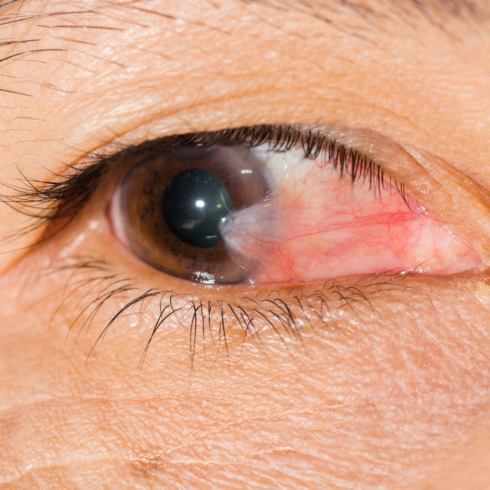 Conditions We Treat - Pterygium — Spectrum Eye