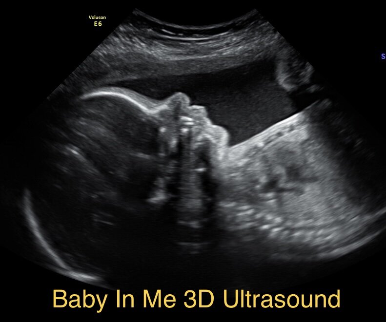 3d Ultrasound
