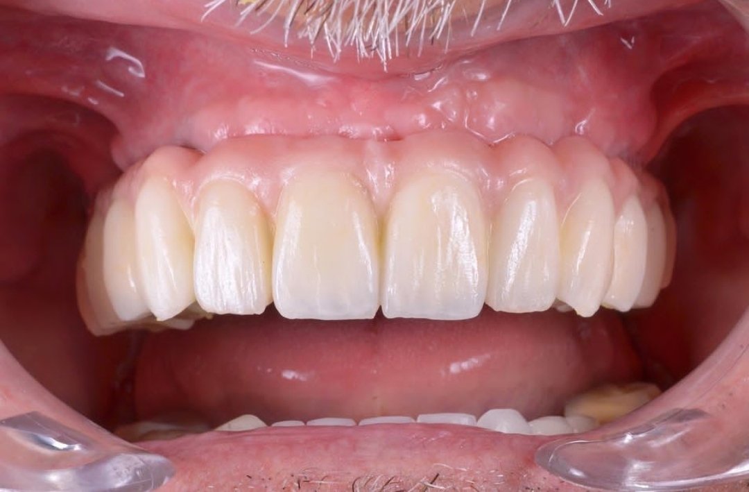 Dental Office in Tijuana — All on 4, Dental Implants, CAD/CAM