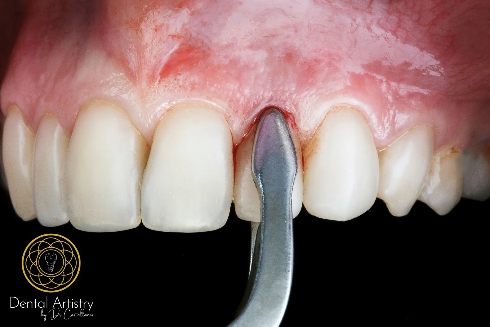 Can You Get a Dental Implant After a Tooth Extraction? | Implant Timing ...
