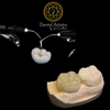 ¿Qué Son los Incrustaciones e Inlays Dentales? | Dental Artistry MX ...