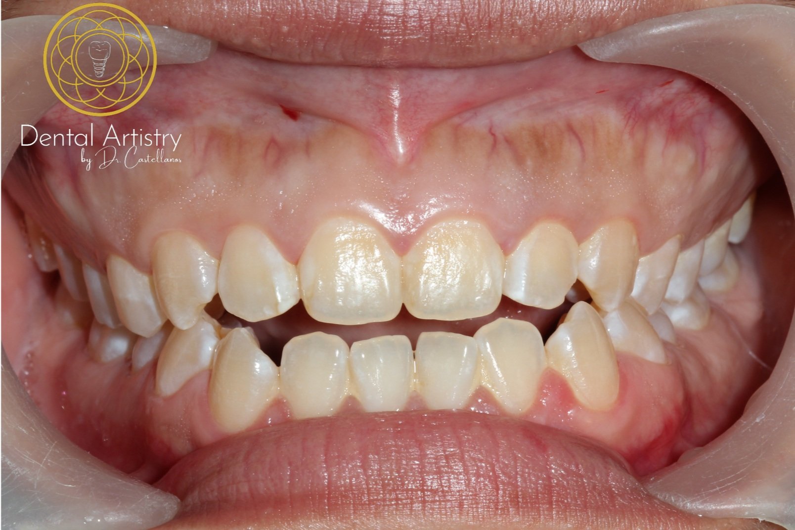 Can Invisalign Fix Open Bites and Closed Bites? | Orthodontic Solutions ...