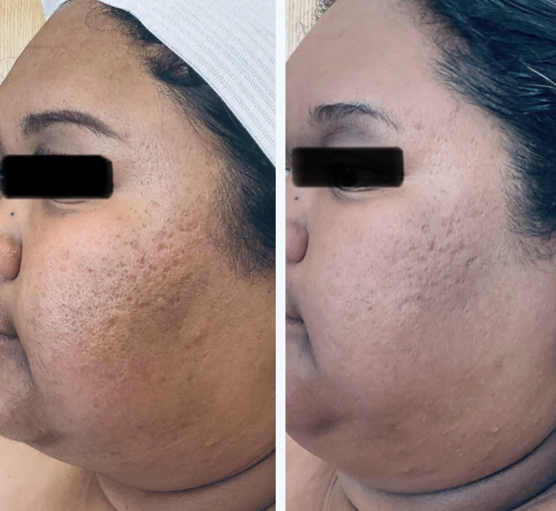 Microneedling Worcester, MA - Skin Micro Needling Near Me — The WooSkin