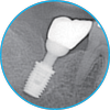 LOCKING TAPER — SLOCK Implant (Korea Dental Implant, Inc.)