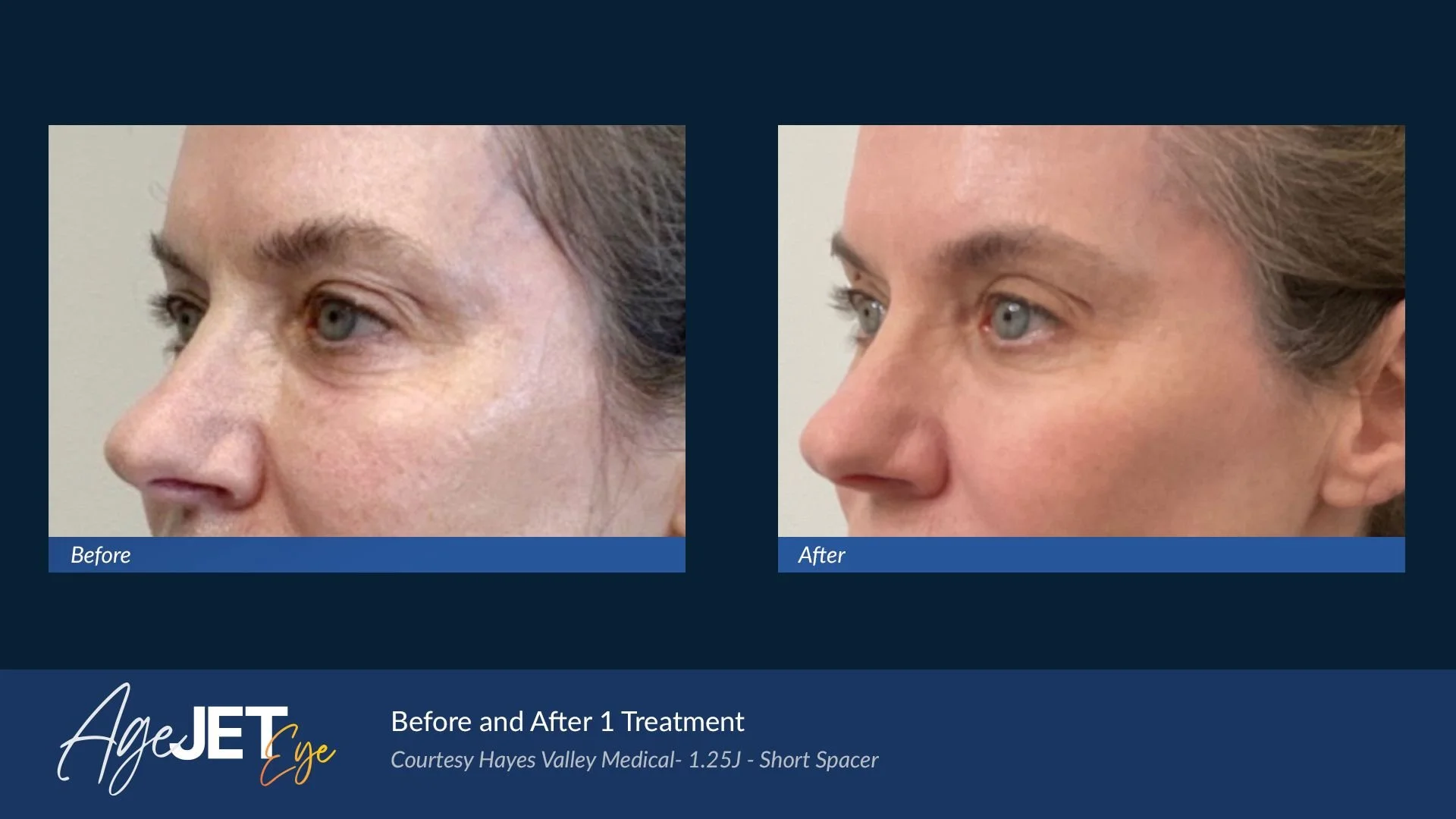 AgeJET Consultation | Advanced Skin Rejuvenation at Rare Wellness ...