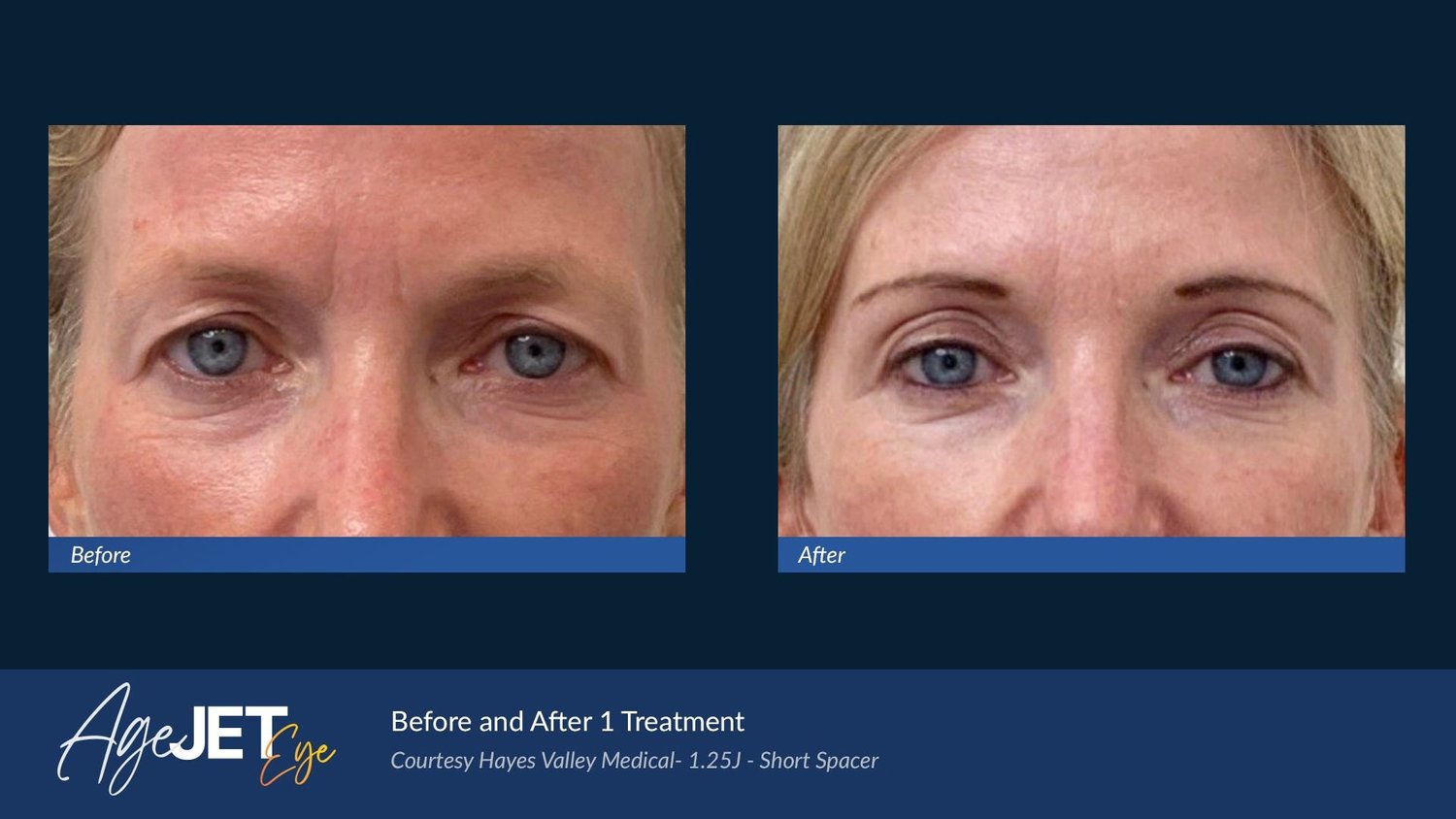 AgeJET Consultation | Advanced Skin Rejuvenation at Rare Wellness ...