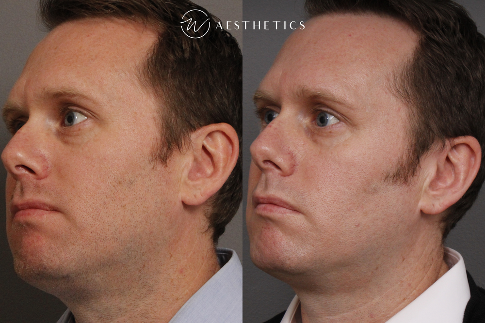 PicoLO Laser Treatment │Laser Rejuvenation │Spokane WA