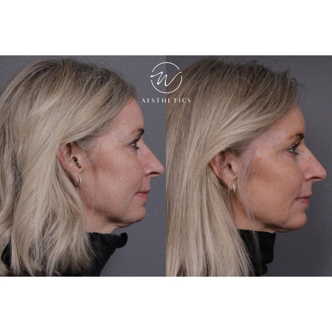 PicoLO Laser Treatment │Laser Rejuvenation │Spokane WA