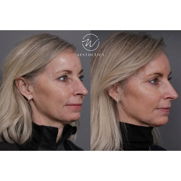 PicoLO Laser Treatment │Laser Rejuvenation │Spokane WA