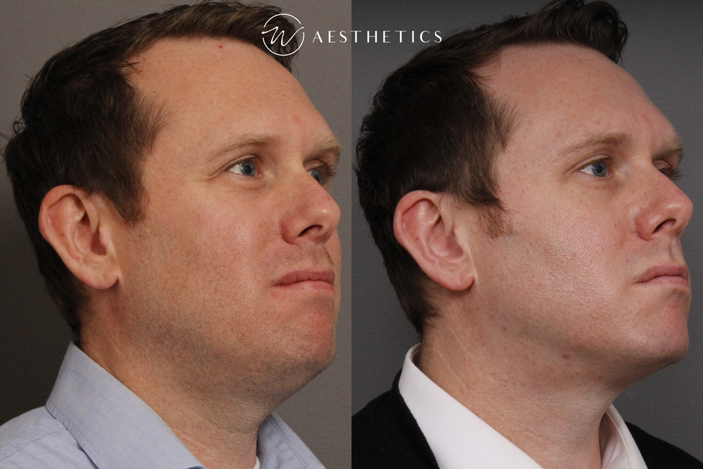 PicoLO Laser Treatment │Laser Rejuvenation │Spokane WA