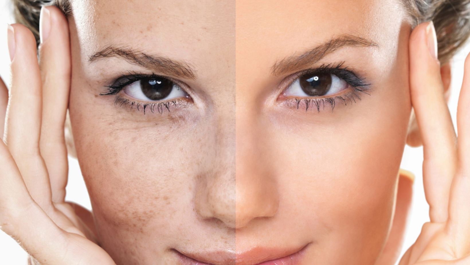 IPL Photo Rejuvenation — Urban Legends