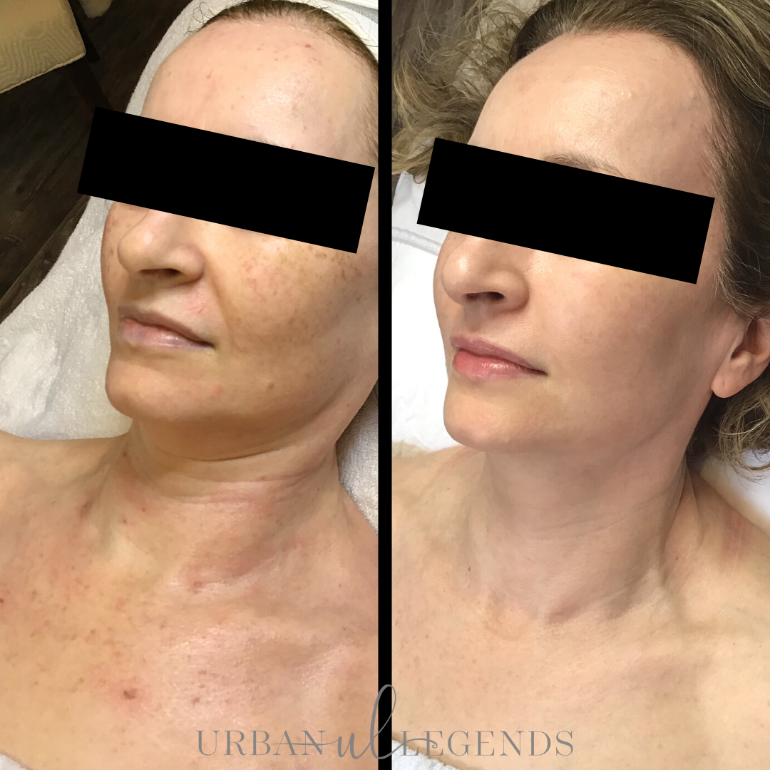 IPL Photo Rejuvenation — Urban Legends