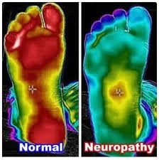 Free Neuropathy Screening — Active Spine & Joint