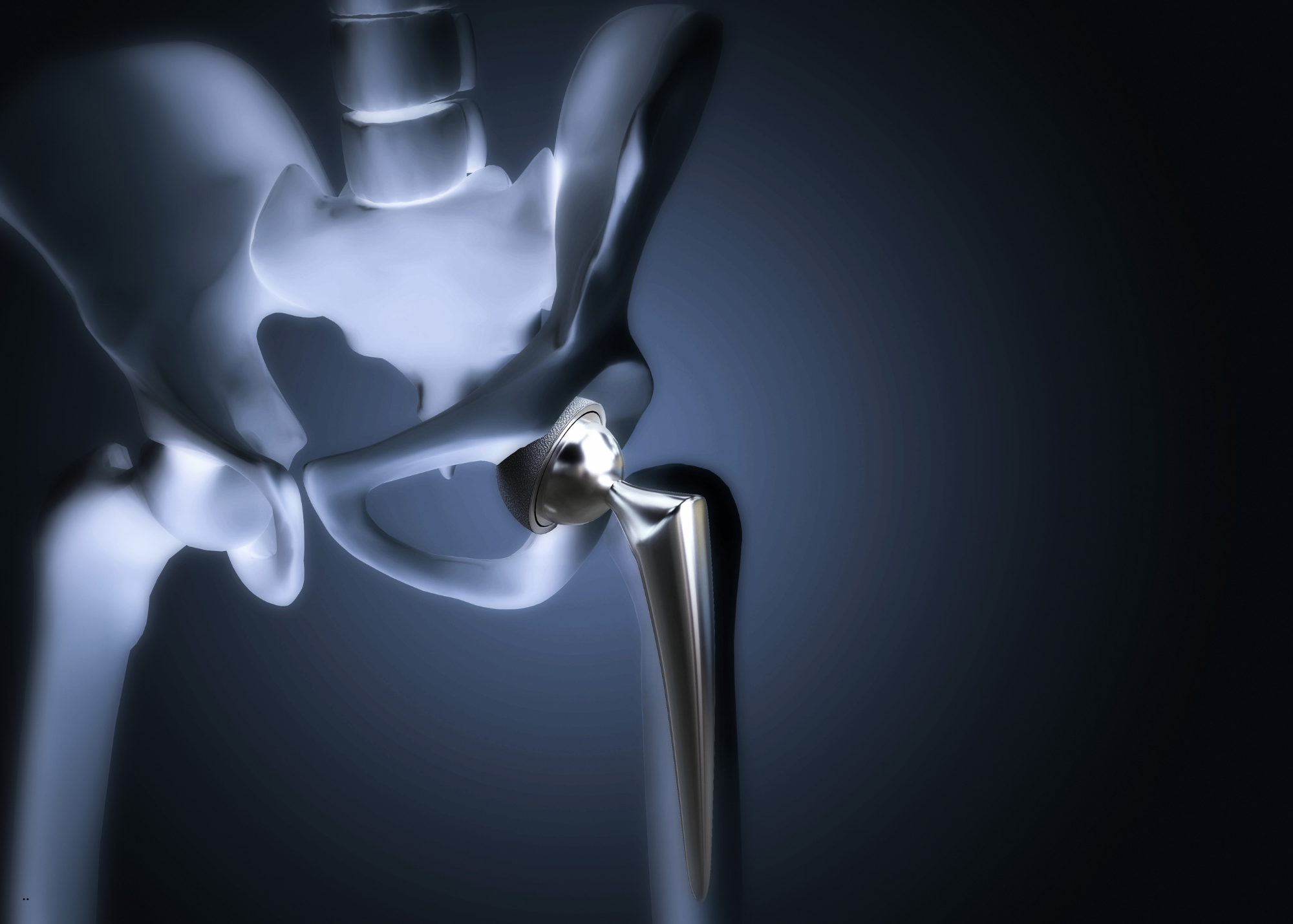 Hip Replacement: Why Younger Patients Are Getting Screwed (Literally ...