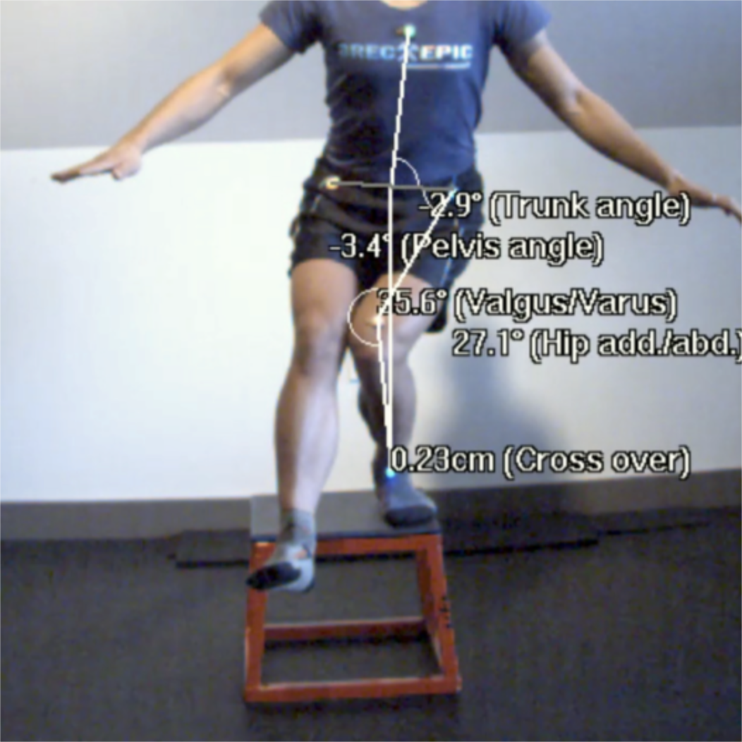 Knee valgus? Ok, so now what? — Revo Physiotherapy and Sports Performance