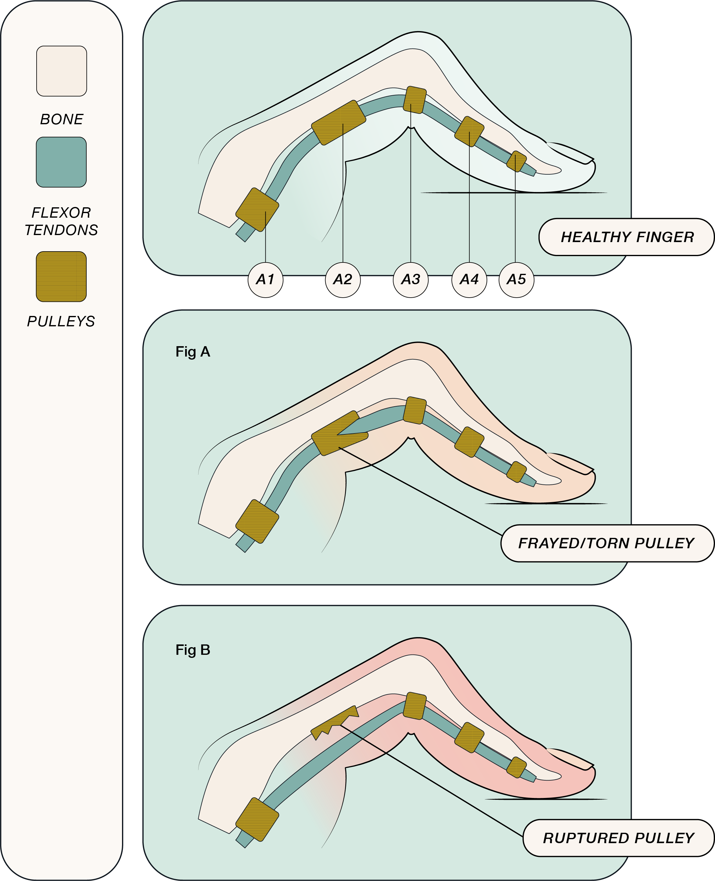 What to do about a severe pulley strain or rupture — Carrie Cooper DPT ...