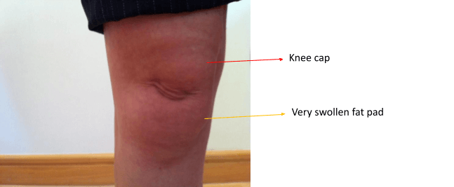 Understanding Hoffa’s Fat Pad Syndrome - Elite Health & Performance