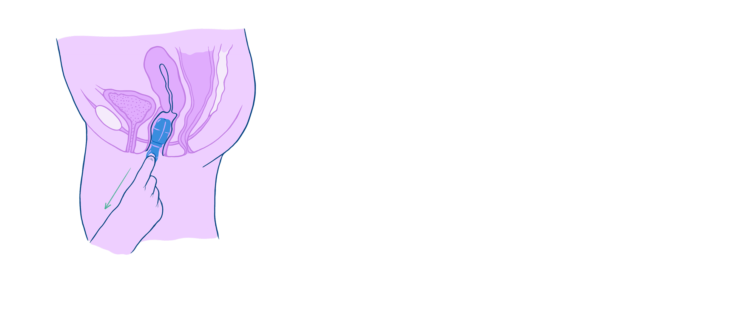 What Is A Pessary For Prolapse _ Pelvic Pessary Care – SKRW