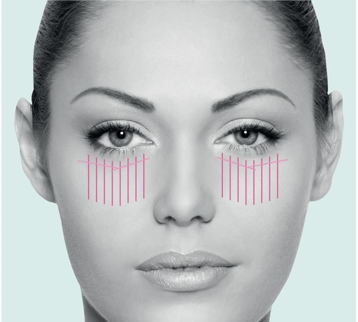 PDO Threads — Good Vibe Medical Wellness Spa