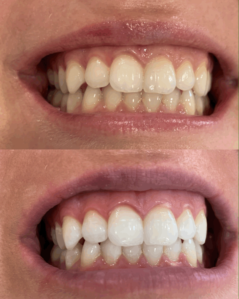 Teeth Whitening — Sugar Magnolia Beauty Studio