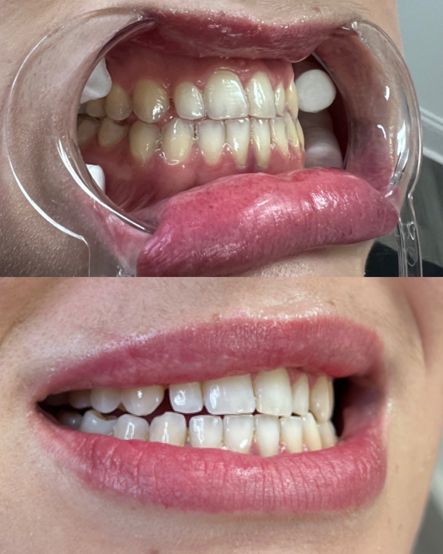 Teeth Whitening — Sugar Magnolia Beauty Studio