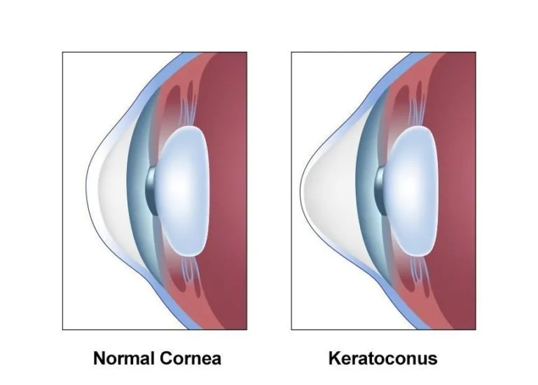 Keratoconus — The Eyeclinic by Dr Cheryl Lee