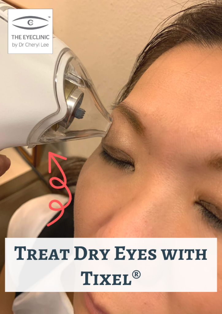 Tixel® Dry Eye & Eyelid Therapy Singapore — The Eyeclinic by Dr Cheryl Lee