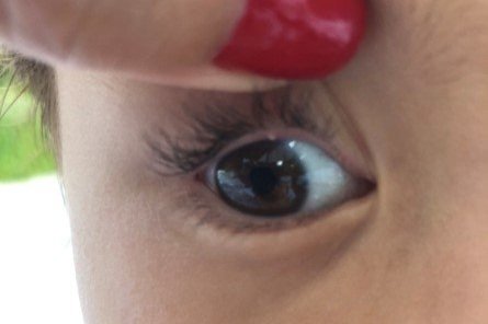 Meibomitis/Marginal gland disease — The Eyeclinic by Dr Cheryl Lee